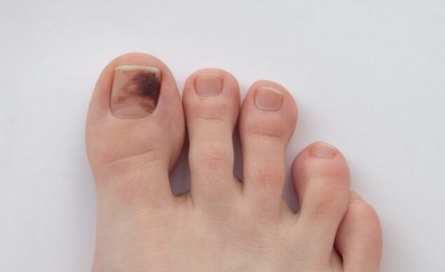 Dark Spots on Toenails: Common Causes and Treatment Tips - Healthtruly.com