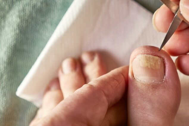 Dark Colored Toenails: Common Causes and Treatment Tips - Healthtruly.com