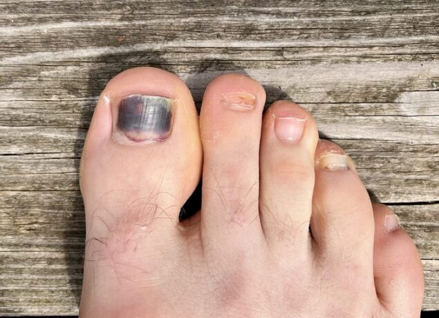 Toes Blackening: Possible Causes and When to See a Doctor - Healthtruly.com